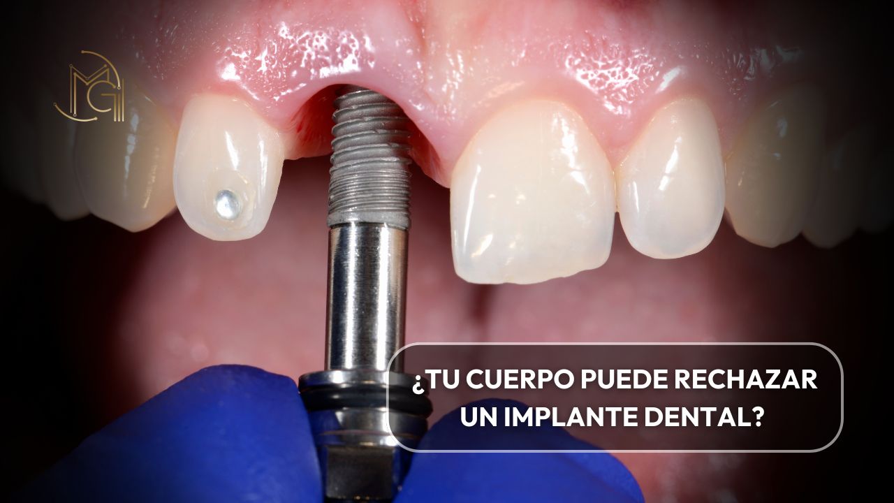 ¿Tu cuerpo puede rechazar un implante dental?