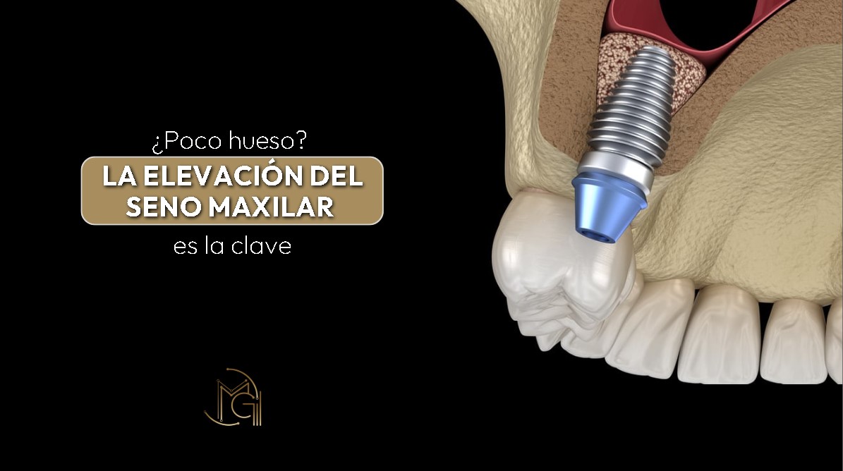 ¿Poco hueso? La elevación del seno maxilar es la clave